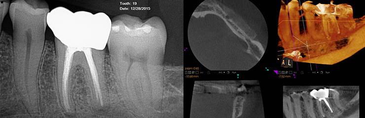 Endodontic Report Archive (1986 - 1993) - Pure Dental Learning